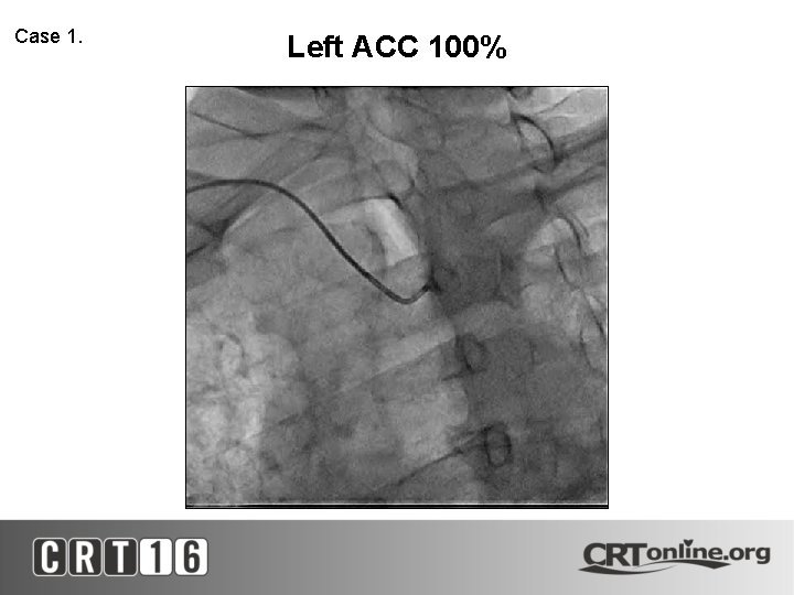 Radial Access for Endovascular Interventions Carotids Subclavian Iliacs