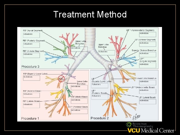Bronchial Thermoplasty and Guided Bronchoscopy Part One Wes