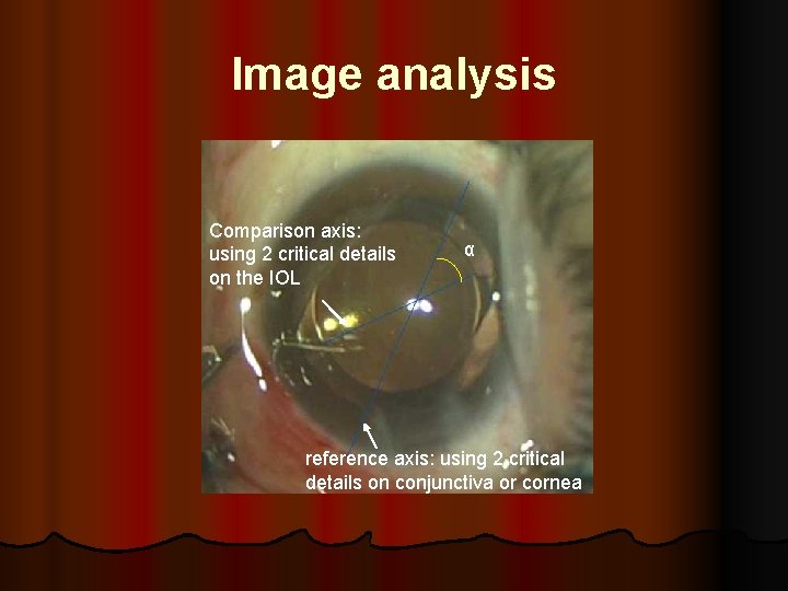 Rotational Stability of SinglePiece Hydrophobic Acrylic Intraocular Lens