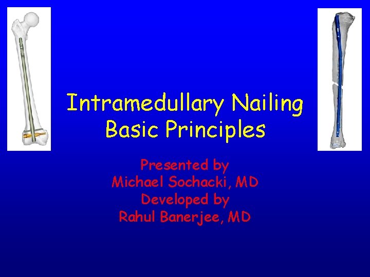 Intramedullary Nailing Basic Principles Presented by Michael Sochacki