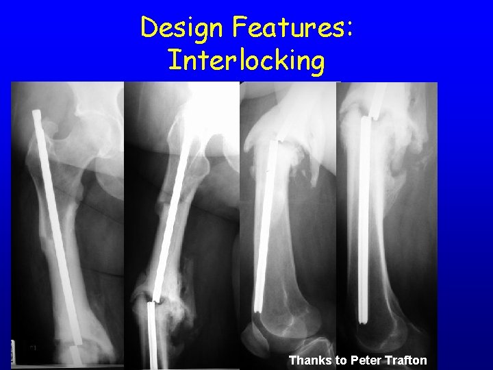 Intramedullary Nailing Basic Principles Presented by Michael Sochacki