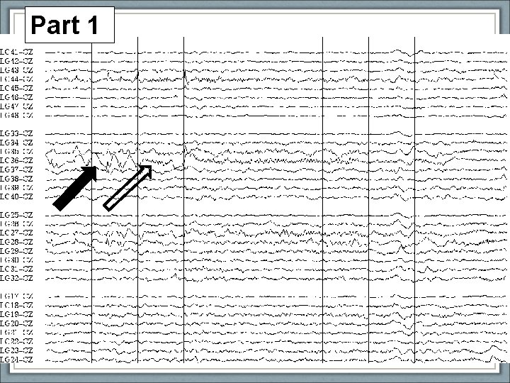 Normal and Abnormal EEG Findings Jeffrey W Britton