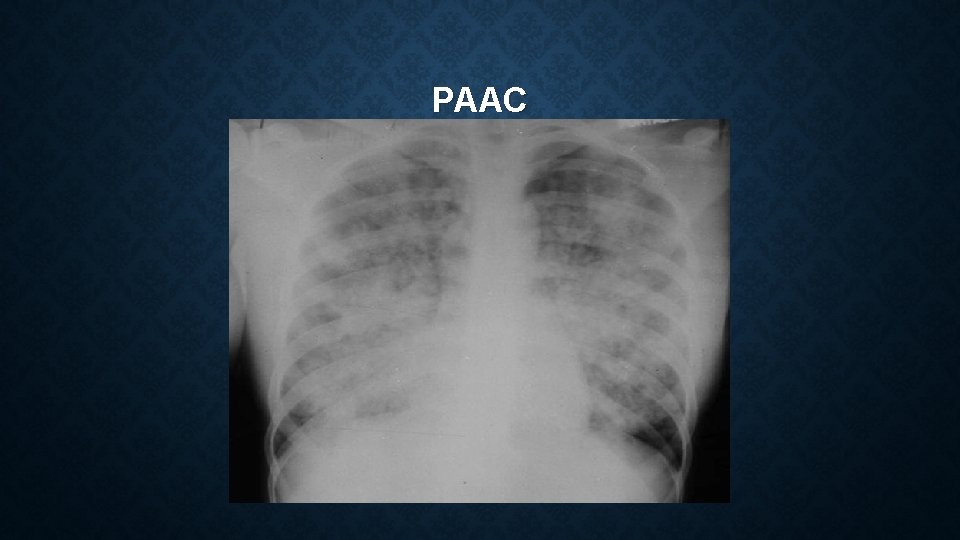 ARDS Dr Cem YILDIRIM PROF Dr Mutlu KARTAL