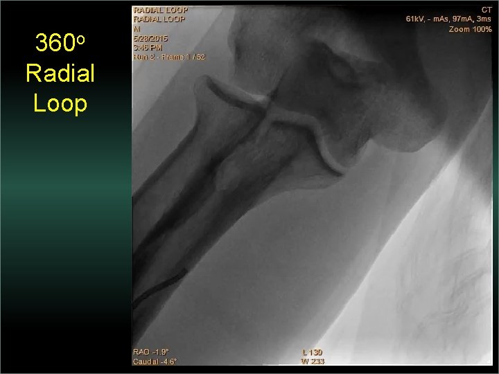 Transradial Interventions Difficult Anatomic Substrate Challenges and ...