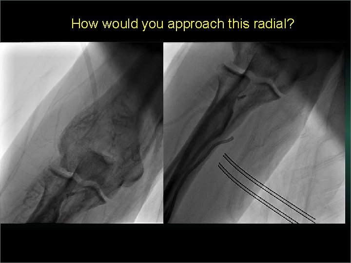 Transradial Interventions Difficult Anatomic Substrate Challenges and ...