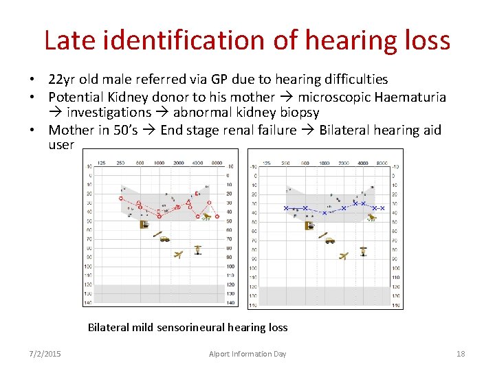 Hearing Loss in Alport Syndrome Dr Sudhira Ratnayake