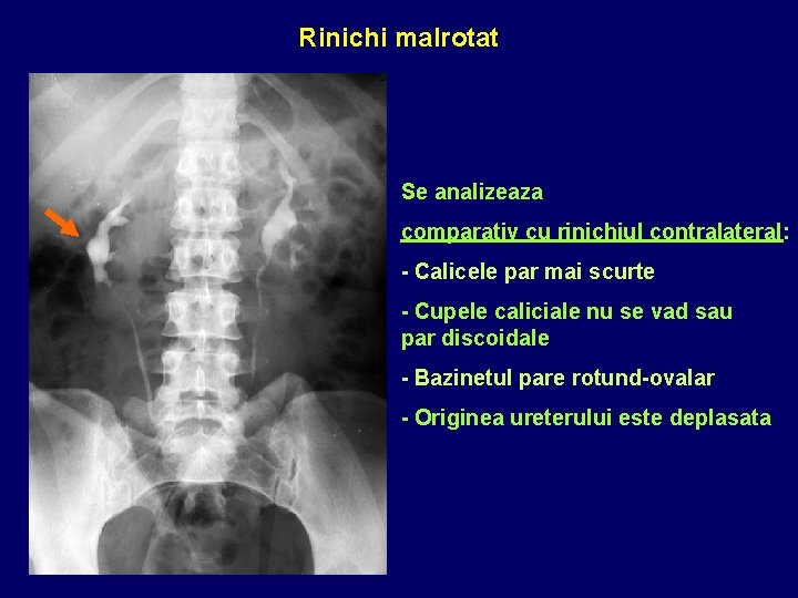Aparat RENOURINAR CALCIFICARI Calcificari in parenchimul renal RRVS