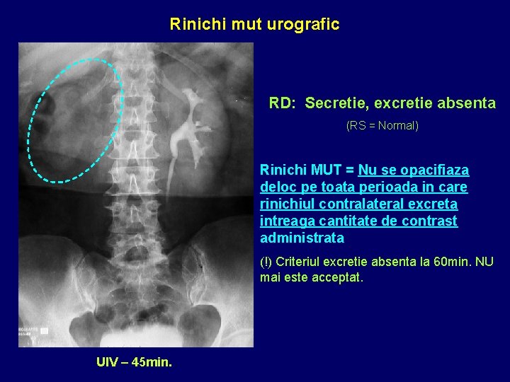 Aparat RENOURINAR CALCIFICARI Calcificari in parenchimul renal RRVS