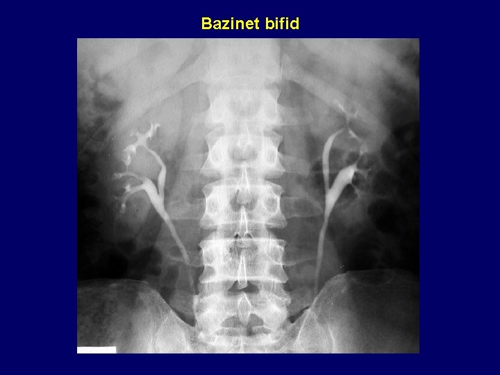 Aparat RENOURINAR CALCIFICARI Calcificari in parenchimul renal RRVS