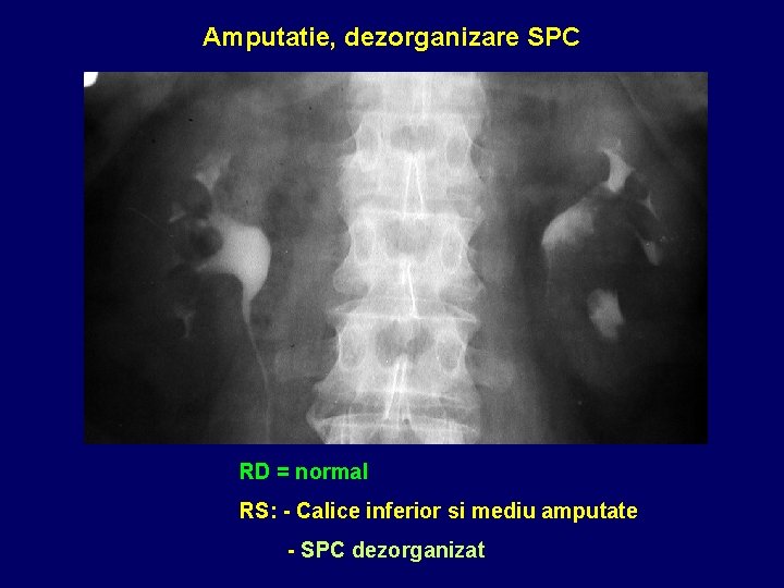 Aparat RENOURINAR CALCIFICARI Calcificari in parenchimul renal RRVS