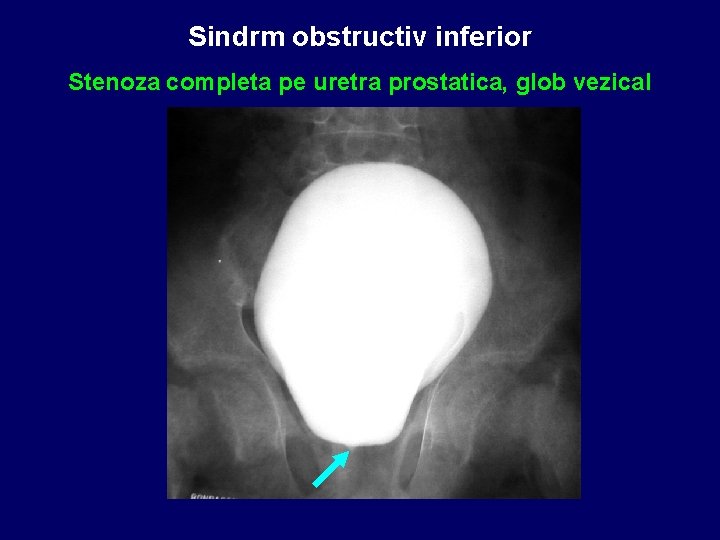 Aparat RENOURINAR CALCIFICARI Calcificari in parenchimul renal RRVS