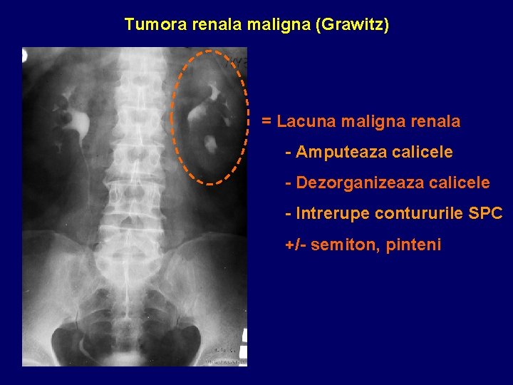 Aparat RENOURINAR CALCIFICARI Calcificari in parenchimul renal RRVS