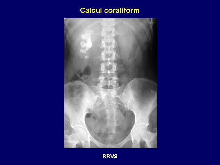 Aparat RENOURINAR CALCIFICARI Calcificari in parenchimul renal RRVS