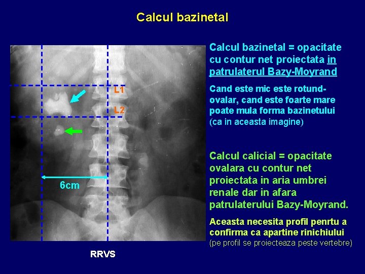 Aparat RENOURINAR CALCIFICARI Calcificari in parenchimul renal RRVS