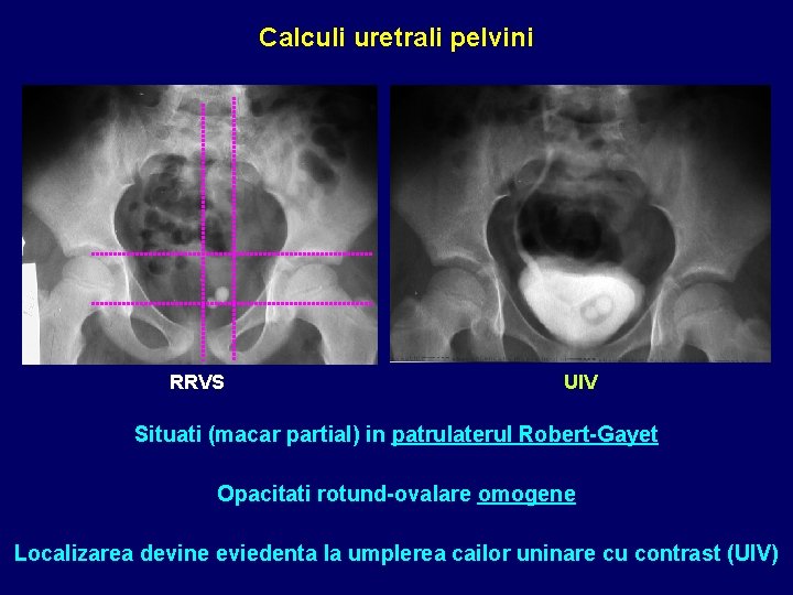 Aparat RENOURINAR CALCIFICARI Calcificari in parenchimul renal RRVS