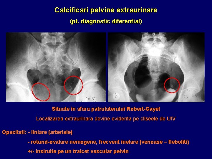 Aparat RENOURINAR CALCIFICARI Calcificari in parenchimul renal RRVS