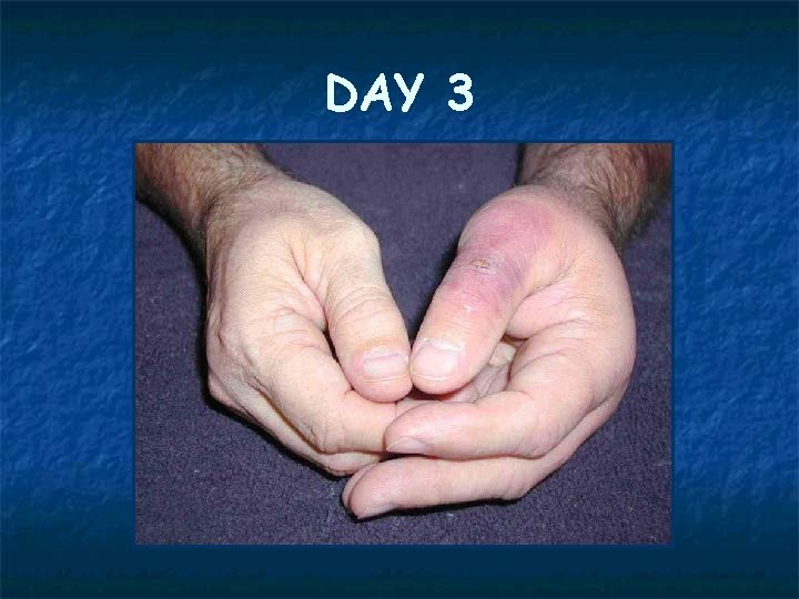 BITES AND STINGS VENOM Hemotoxin Neurotoxin Local Tissue