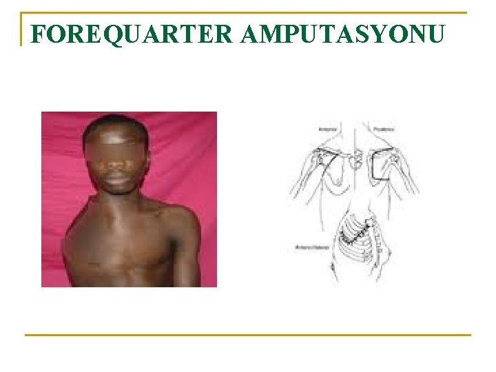 PROTEZ REHABLTASYONU TERMNOLOJ n AMPUTASYON n Trans Parsiyel