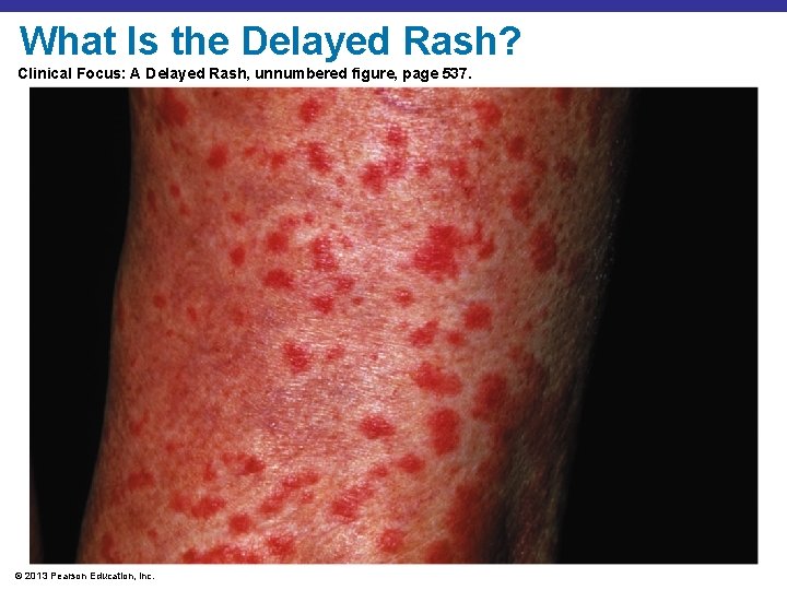 Chapter 19 Disorders Associated with the Immune System