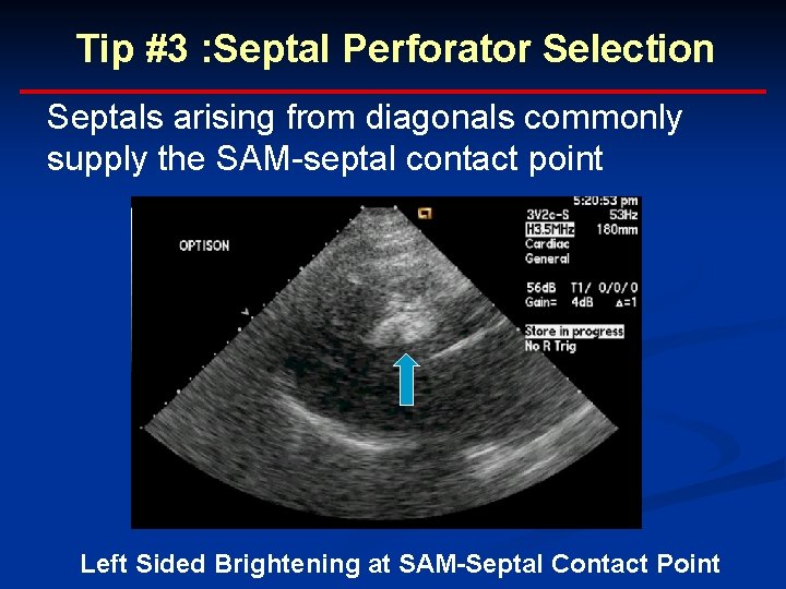 When and How to Perform Alcohol Septal Ablation