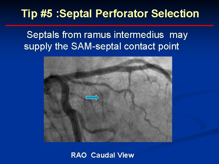 When and How to Perform Alcohol Septal Ablation