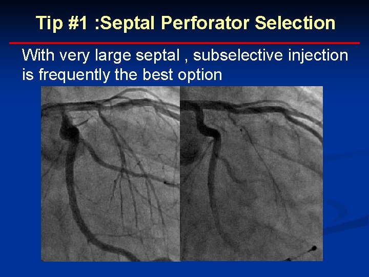 When and How to Perform Alcohol Septal Ablation