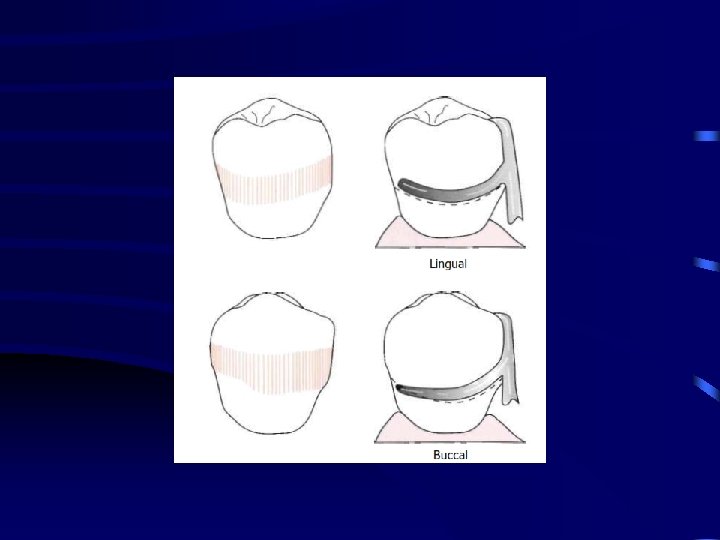 Biomechanics of Removable Partial Denture DR SHAISTA AFROZ