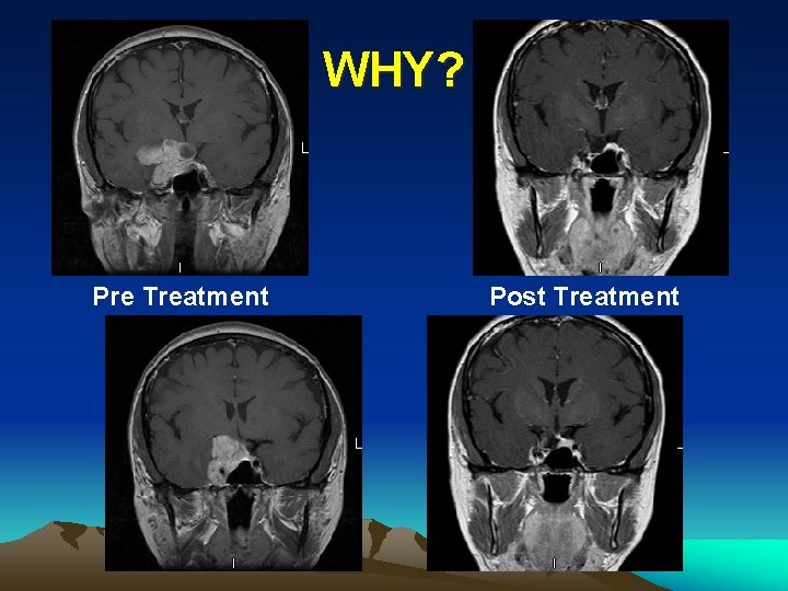 Diagnosis and Treatment of Pituitary Tumors Kevin O