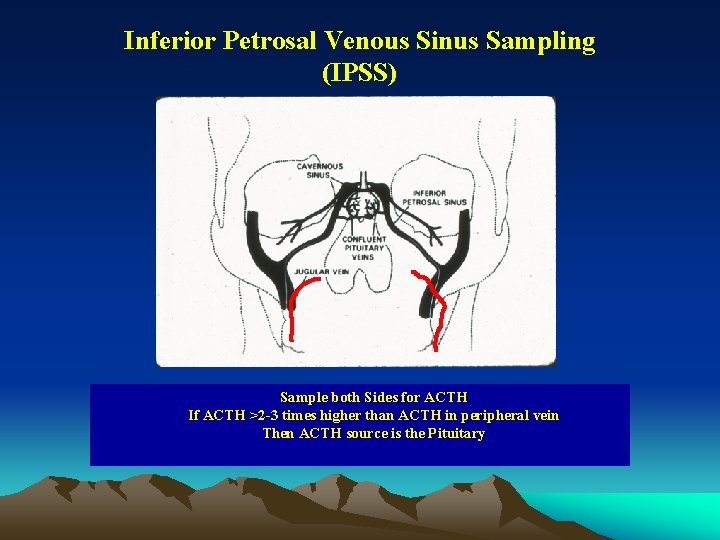 Diagnosis and Treatment of Pituitary Tumors Kevin O