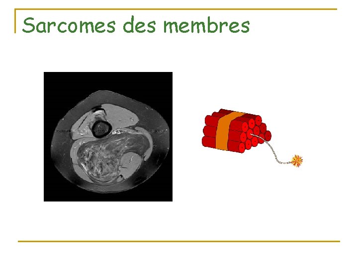 Sarcomes des tissus mous Dr P Meeus Service