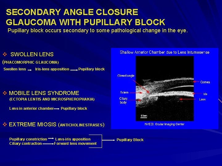 ANGLECLOSURE GLAUCOMA RISK FACTORS AND PATHOGENESIS SPEAKER KUMAR