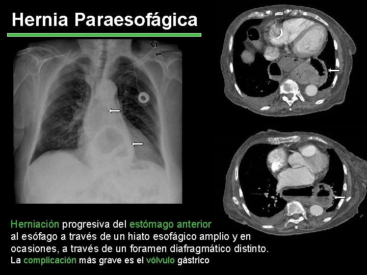 HERNIAS DIAFRAGMTICAS CLASIFICACIN Hernia hiatal herniacin del estmago