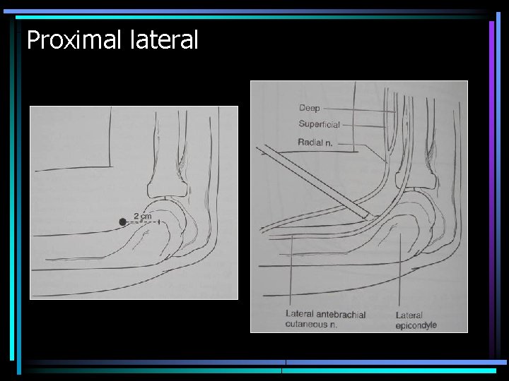 ELBOW CONTRACTURES ARTHROSCOPIC RELEASE Nguyen Trong Anh et