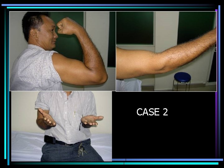 ELBOW CONTRACTURES ARTHROSCOPIC RELEASE Nguyen Trong Anh et