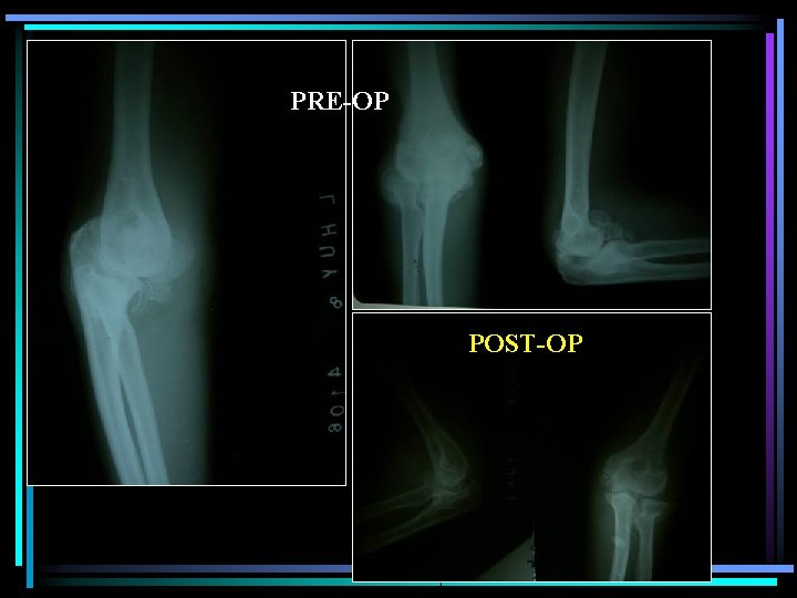 ELBOW CONTRACTURES ARTHROSCOPIC RELEASE Nguyen Trong Anh et