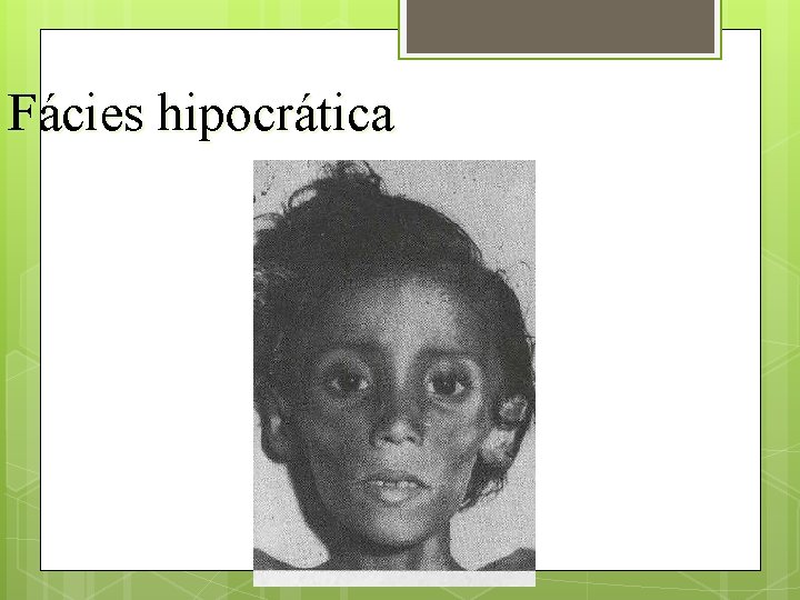 Facies Hippocratica