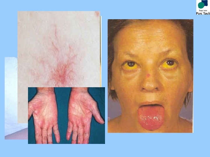 Hemorragia Digestiva Alta Urgencias Junio 2011 Hemorragia digestiva