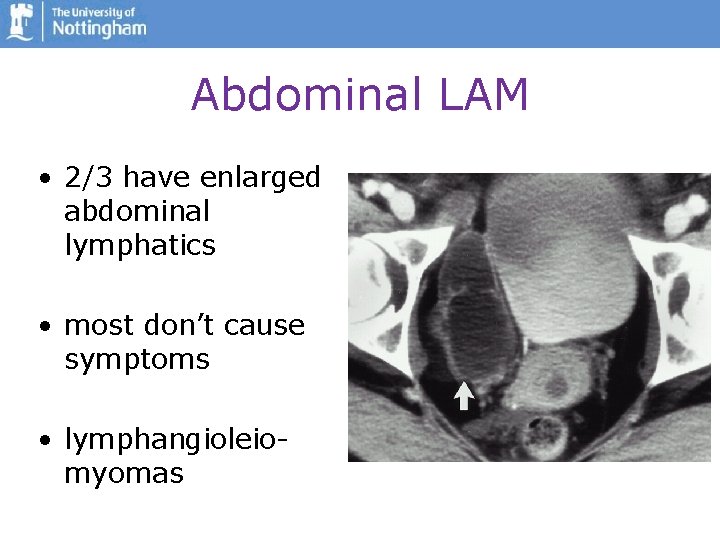 LAM symptoms screening assessment and treatment Simon Johnson
