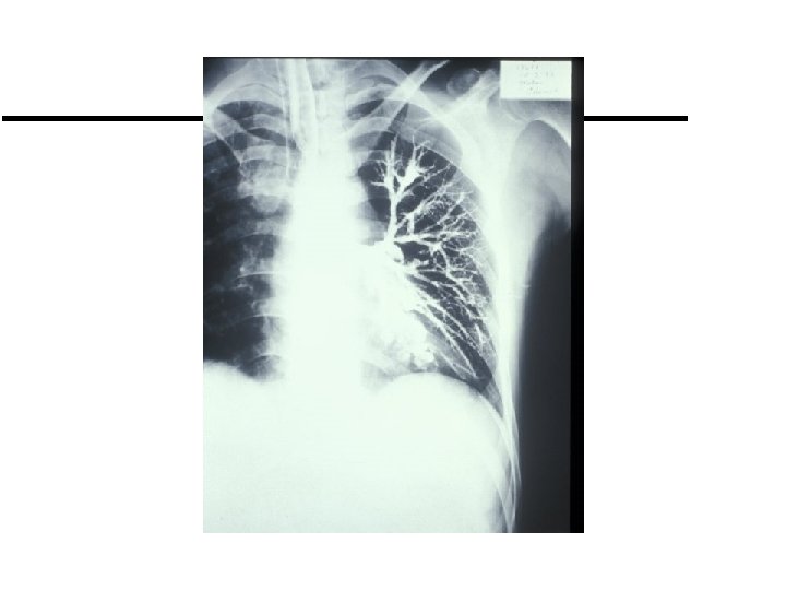 PRIMARY ANTIBODY DEFICIENCY PAD BRONCHIECTASIS UKPIN BTS GUIDELINES