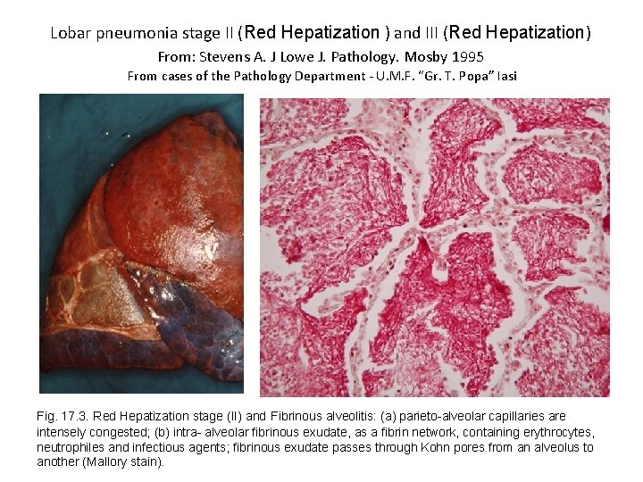 Respiratory pathology 1 Lobar pneumonia From Stevens A