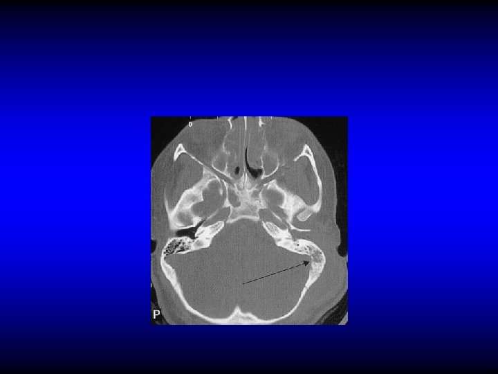 COMPLICATIONS OF SUPPURATIVE OTITIS MEDIA ROUTES OF SPREAD