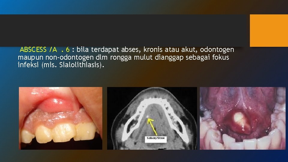 PERANAN GIGI DAN RONGGA MULUT PADA FOKAL INFEKSI