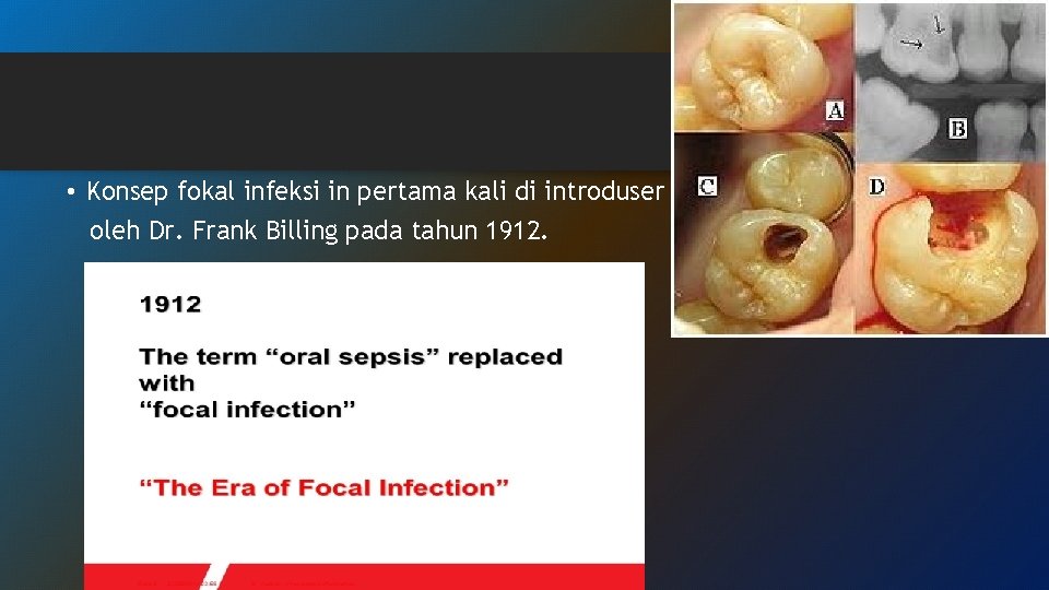 PERANAN GIGI DAN RONGGA MULUT PADA FOKAL INFEKSI