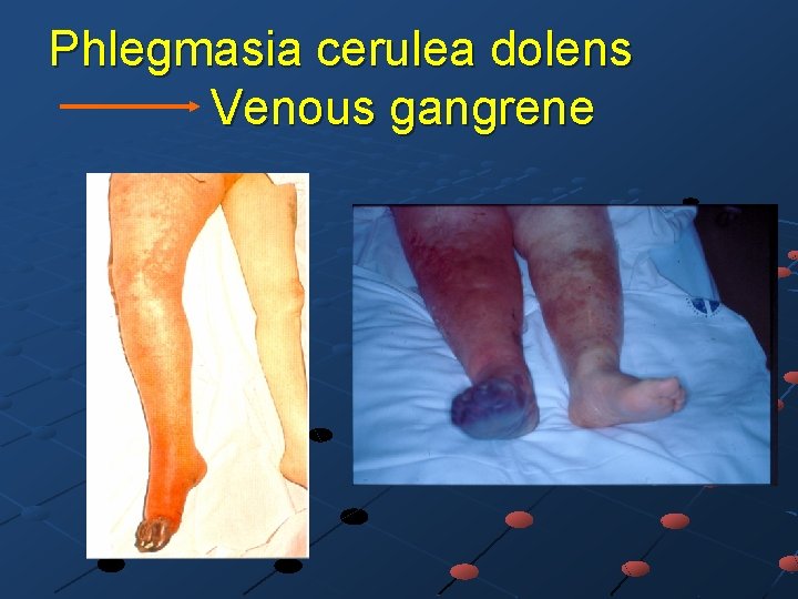 Definition formation of a blood clot in one