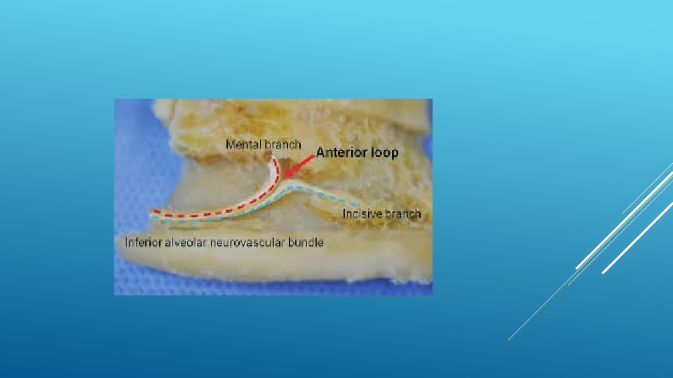 MENTAL FORAMEN LOCATION AND DIMENSIONS OF THE MENTAL