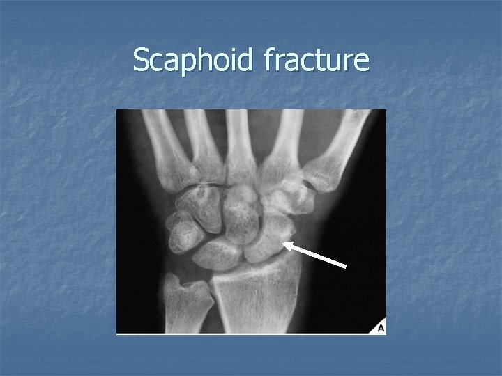 Fractures and dislocations of the wrist Dr Ihab