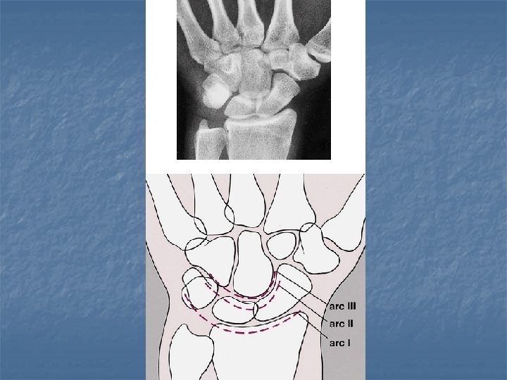 Fractures and dislocations of the wrist Dr Ihab