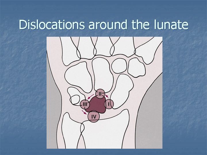 Fractures and dislocations of the wrist Dr Ihab