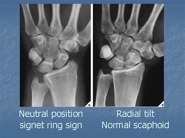 Fractures and dislocations of the wrist Dr Ihab
