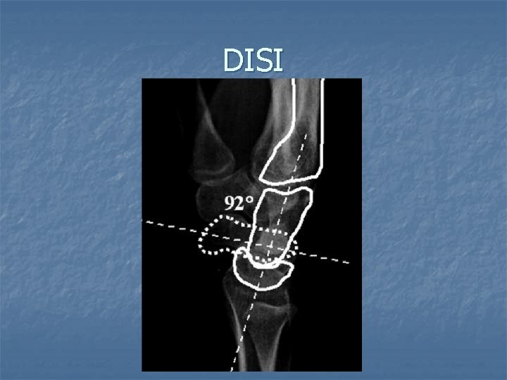 Fractures and dislocations of the wrist Dr Ihab
